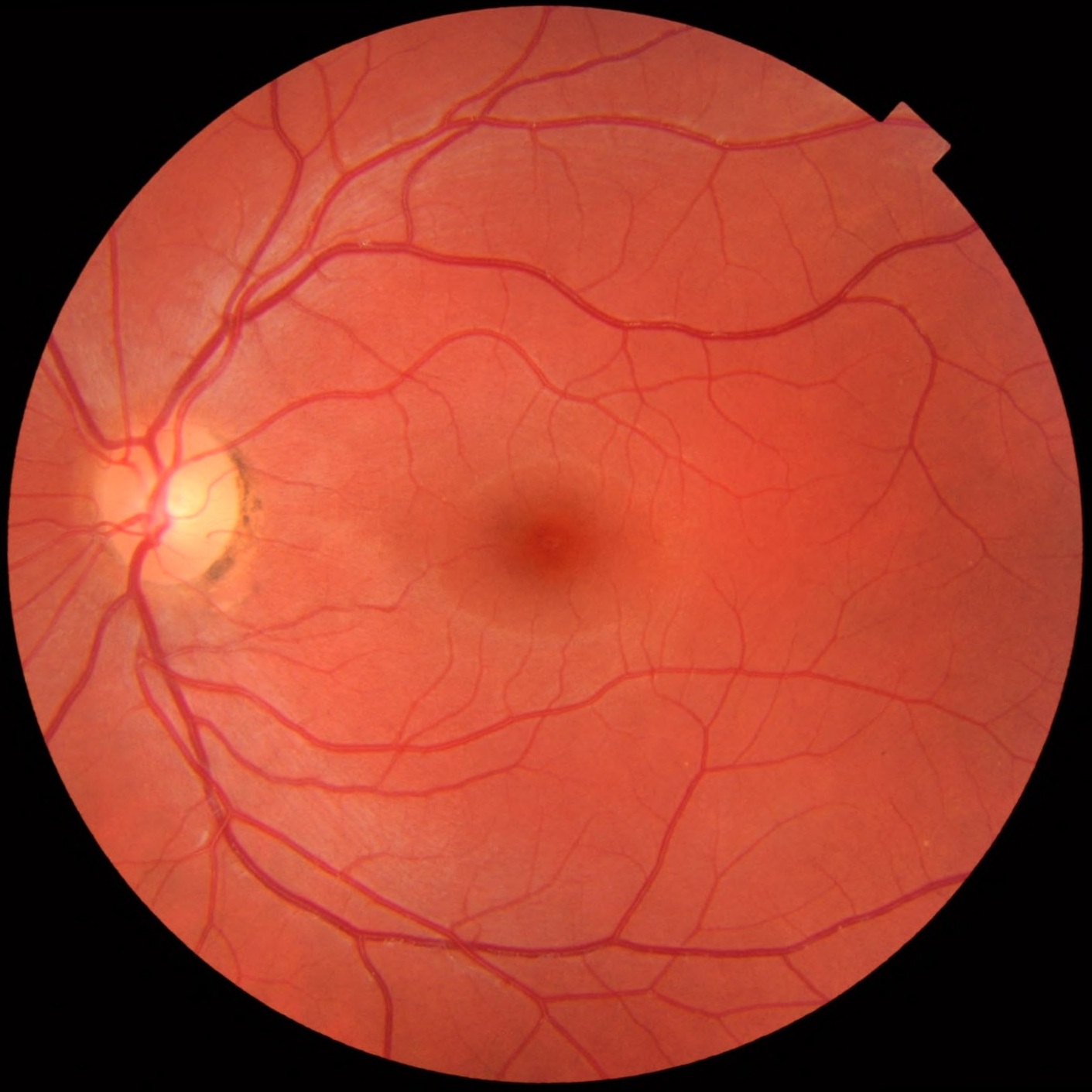 Mapeamento de Retina - Signorelli Oftalmologia